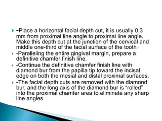 dental veneers | PPTX