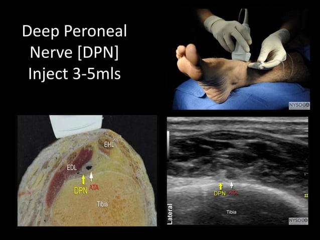 Ultrasound Guided Ankle Block | PPTX | Foot Health | Diseases and ...