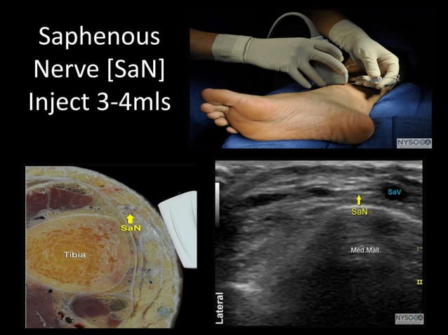 Ultrasound Guided Ankle Block | PPTX | Foot Health | Diseases and ...