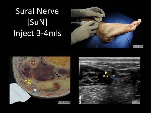 Ultrasound Guided Ankle Block | PPTX | Foot Health | Diseases and ...