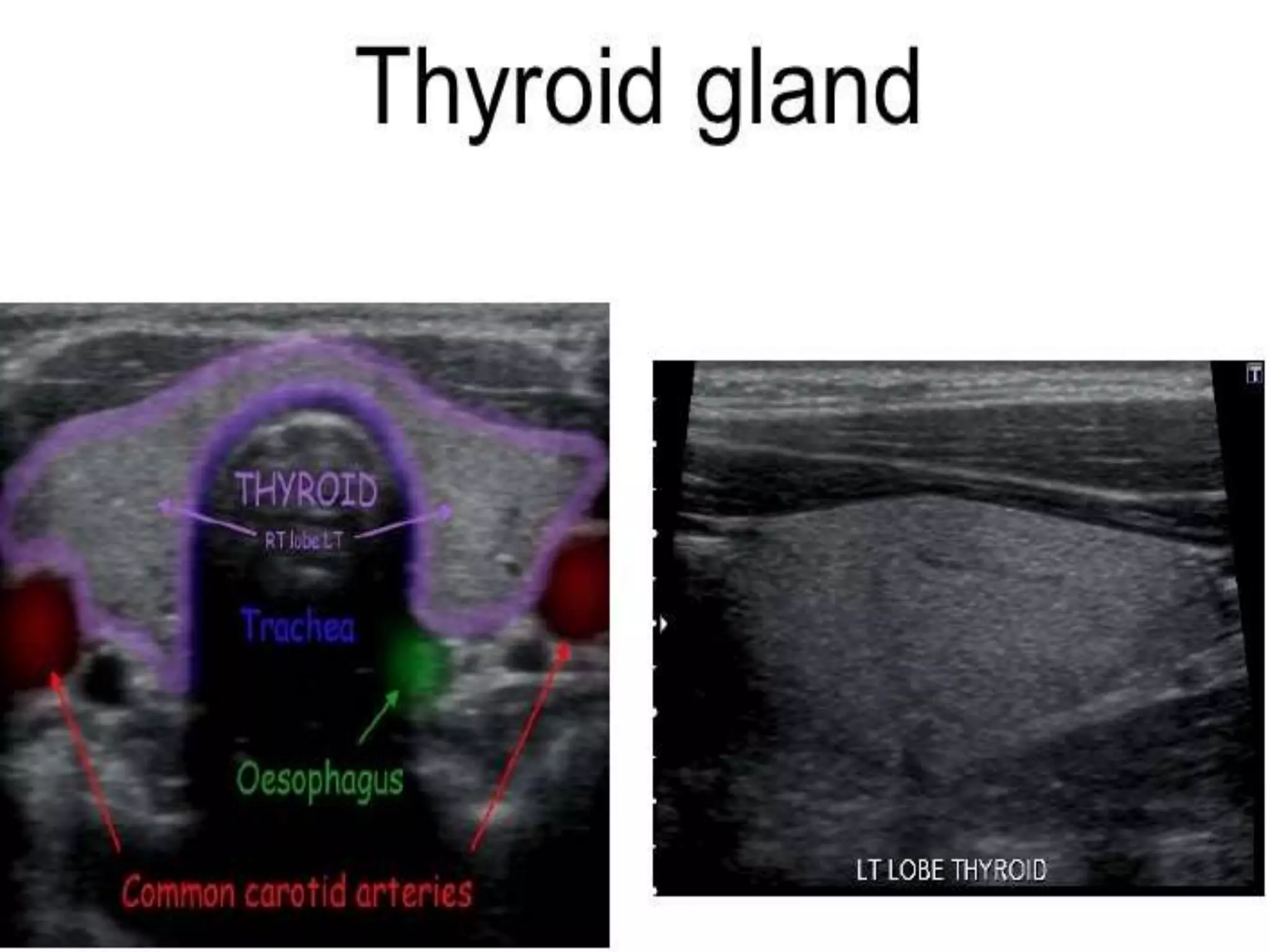 Presentation1.pptx, radiological imaging of the thyroid gland diseases ...