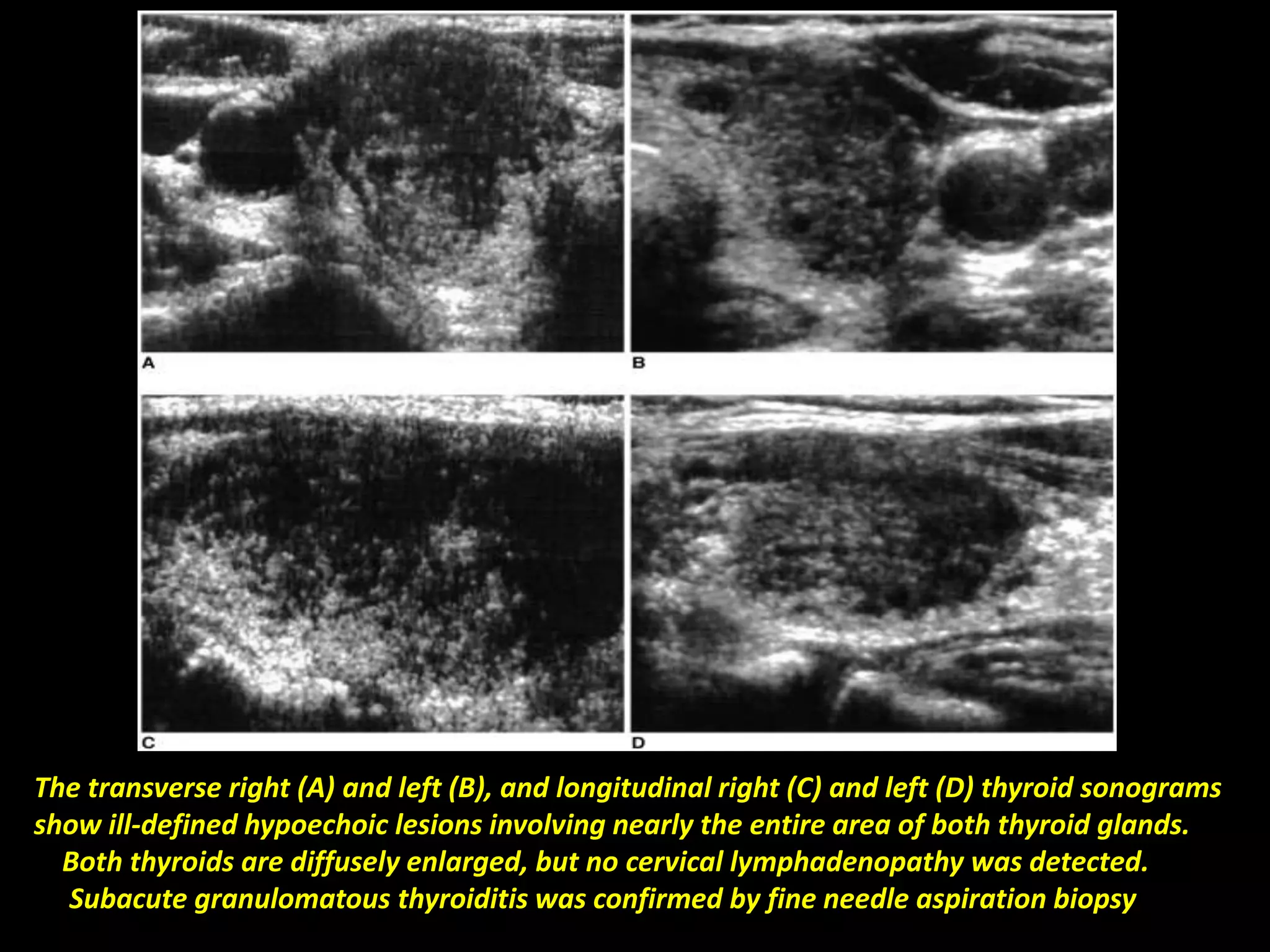 Presentation1.pptx, radiological imaging of the thyroid gland diseases ...
