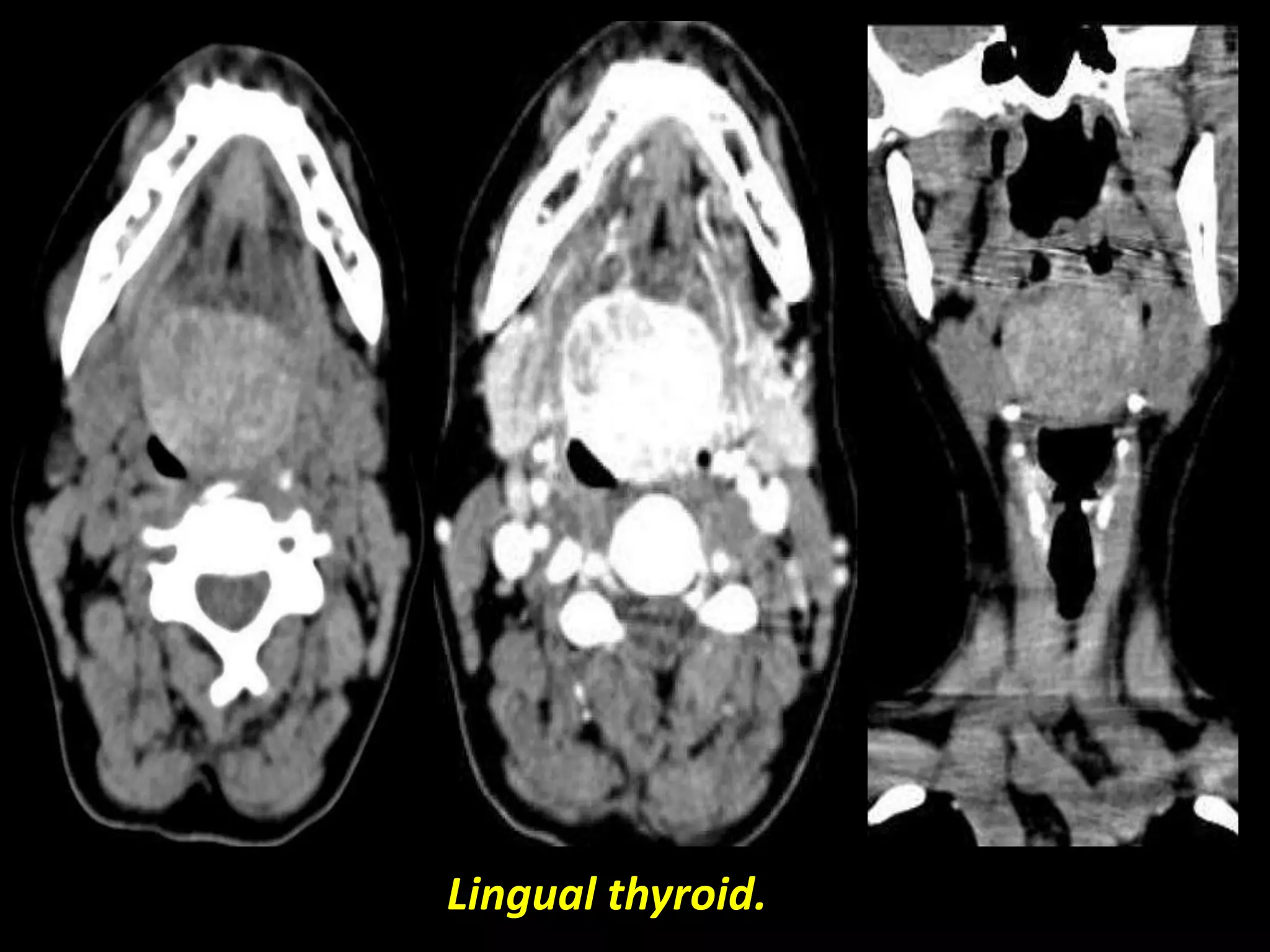 Presentation1.pptx, radiological imaging of the thyroid gland diseases ...