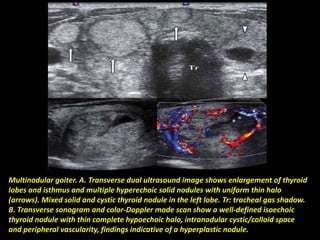 Presentation1.pptx, radiological imaging of the thyroid gland diseases ...