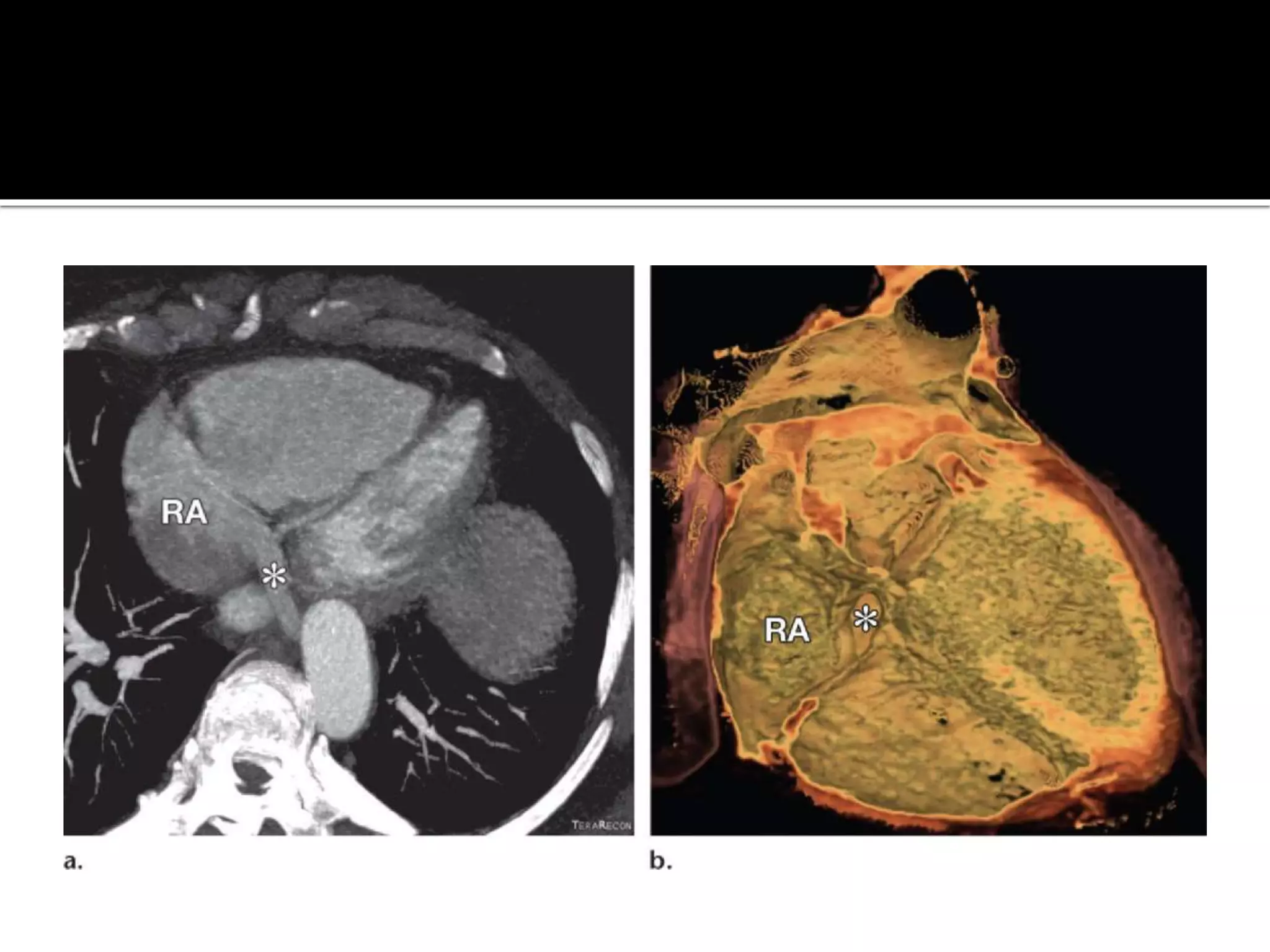 segment approach to congenital heart diseases | PPTX