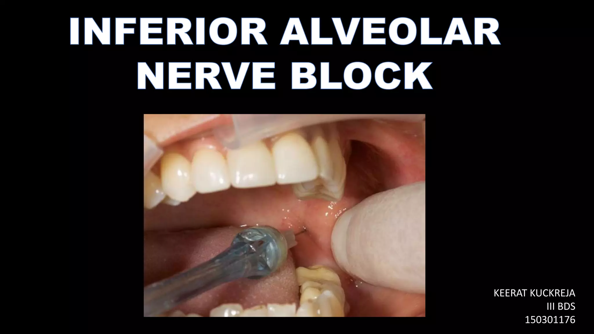 INFERIOR ALVEOLAR NERVE BLOCK | PPT