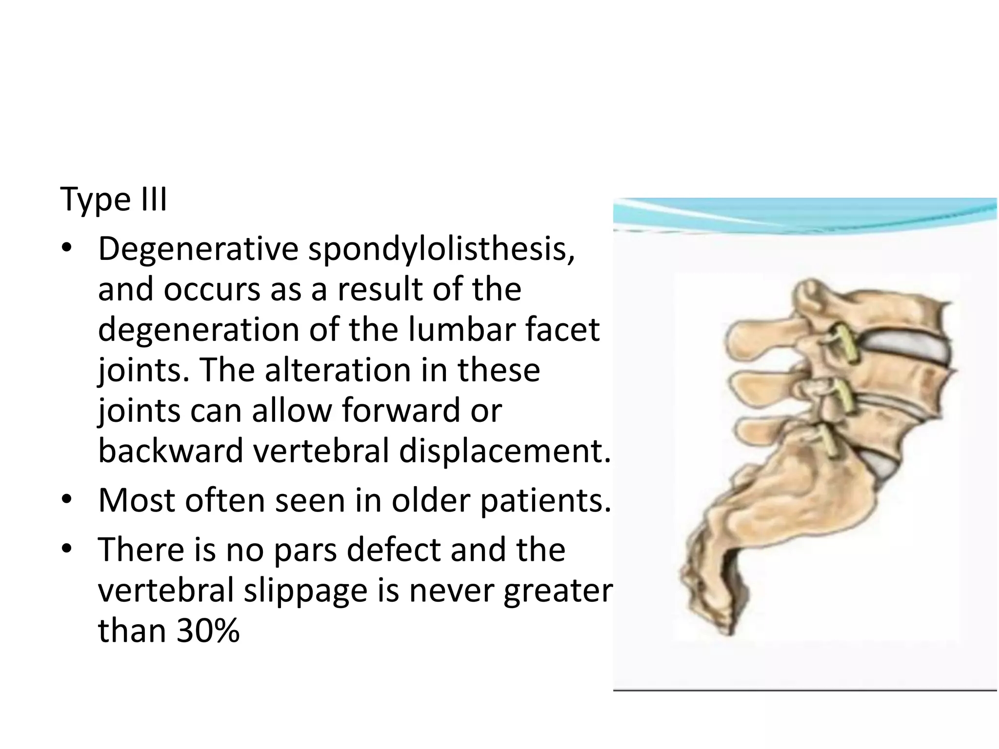 spondylo listhesis | PPTX