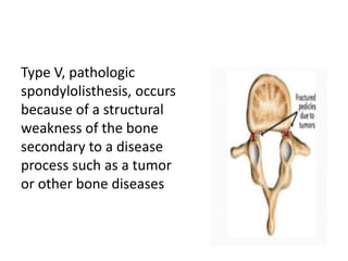 spondylo listhesis | PPTX