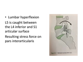 spondylo listhesis | PPTX