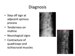 spondylo listhesis | PPTX