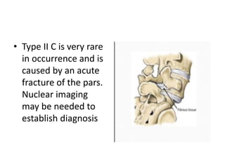 spondylo listhesis | PPTX