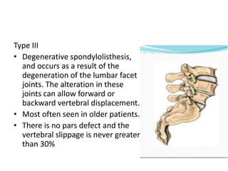 spondylo listhesis | PPTX