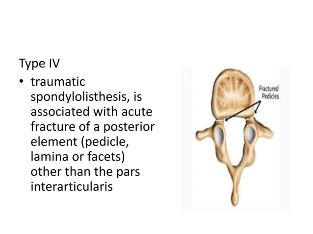 spondylo listhesis | PPTX