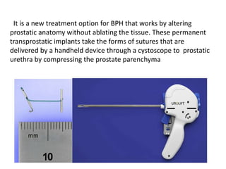 prostatic urethral lift | PPTX