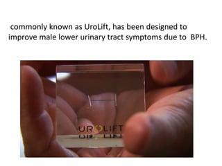 prostatic urethral lift | PPTX