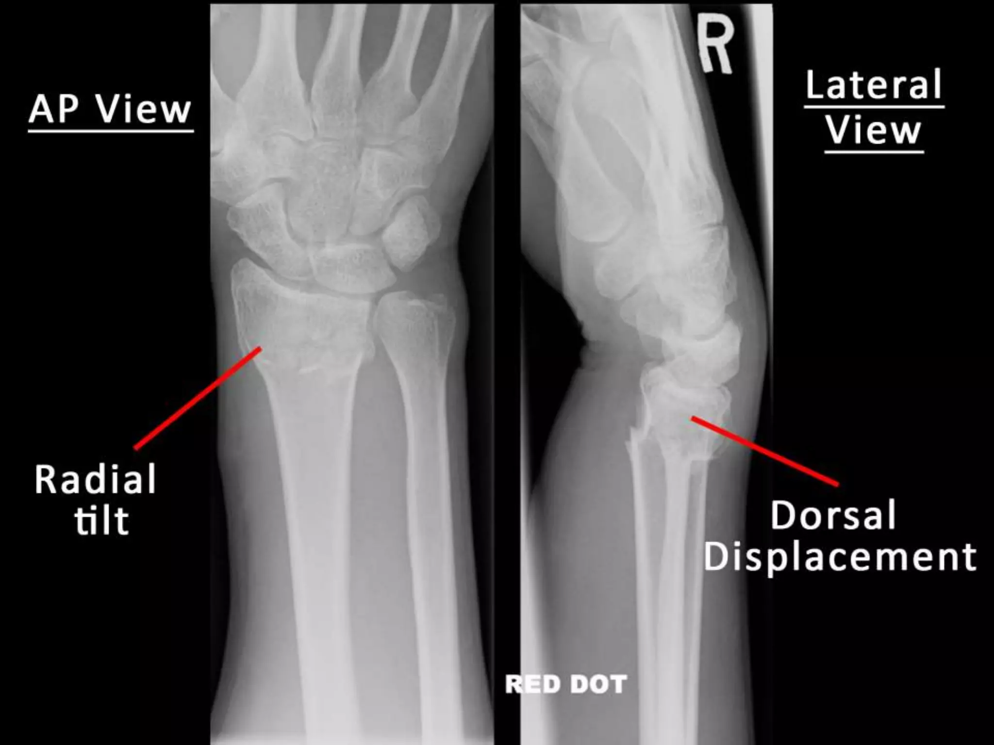 Distal End Radius Fractures - Colles, Smiths & Bartons | PPTX