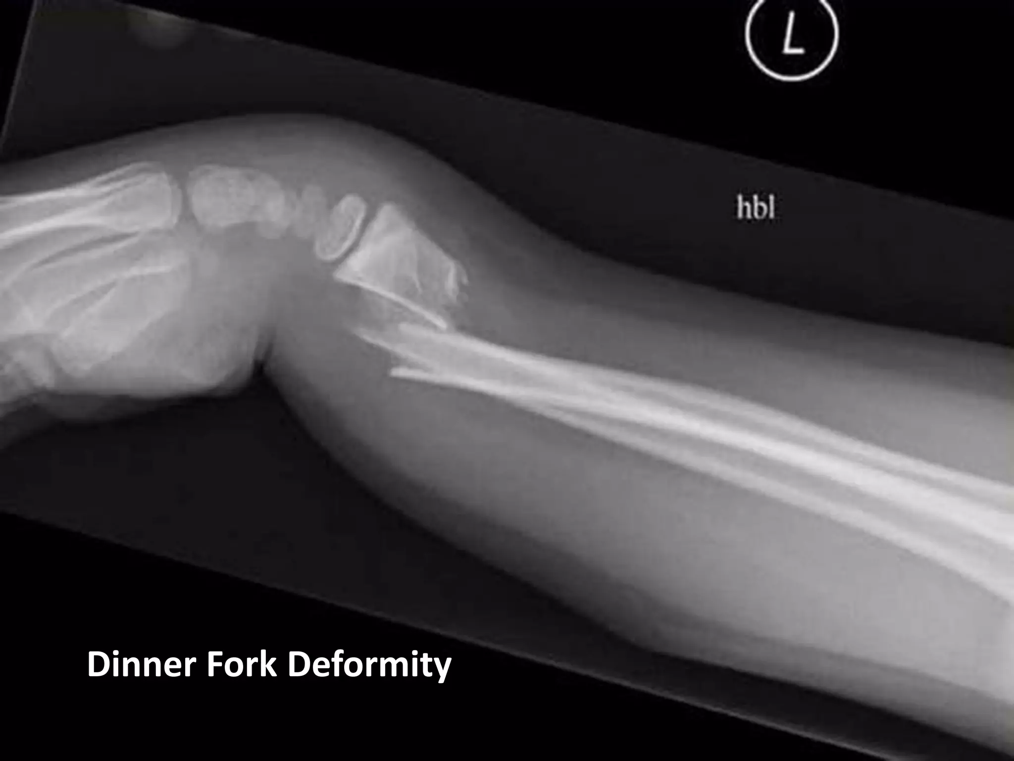 Distal End Radius Fractures - Colles, Smiths & Bartons | PPTX