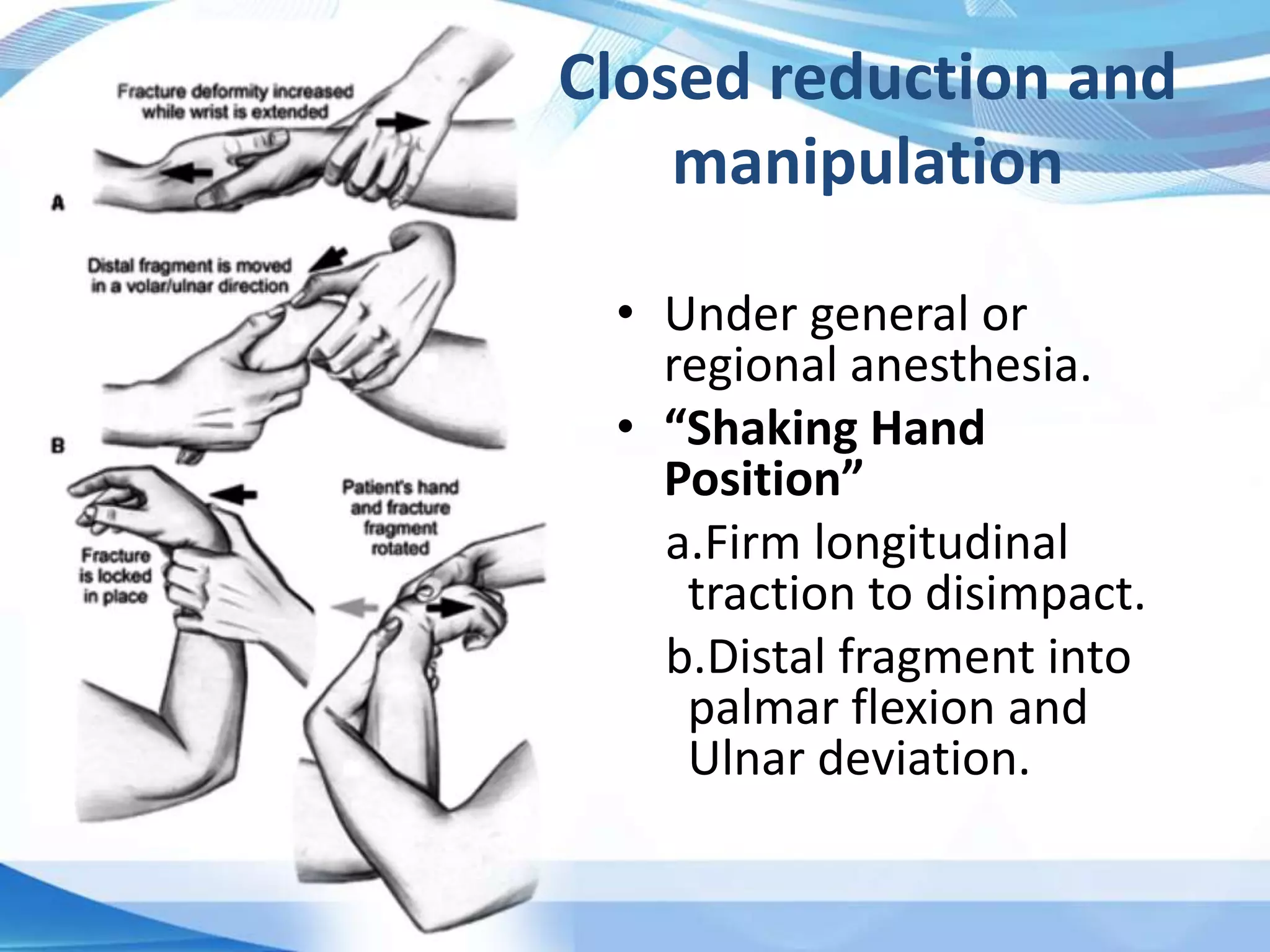 Distal End Radius Fractures - Colles, Smiths & Bartons | PPTX