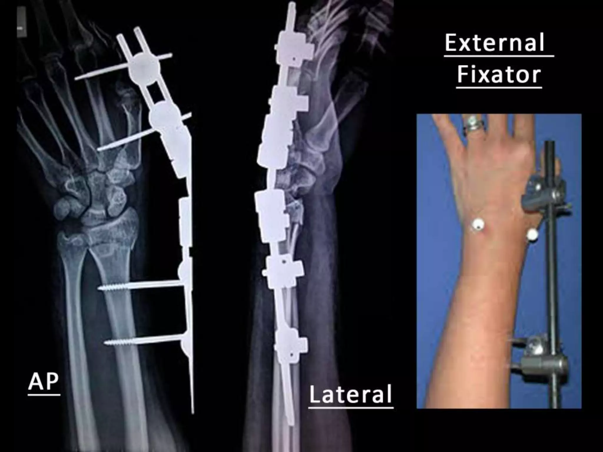 Distal End Radius Fractures - Colles, Smiths & Bartons | PPTX