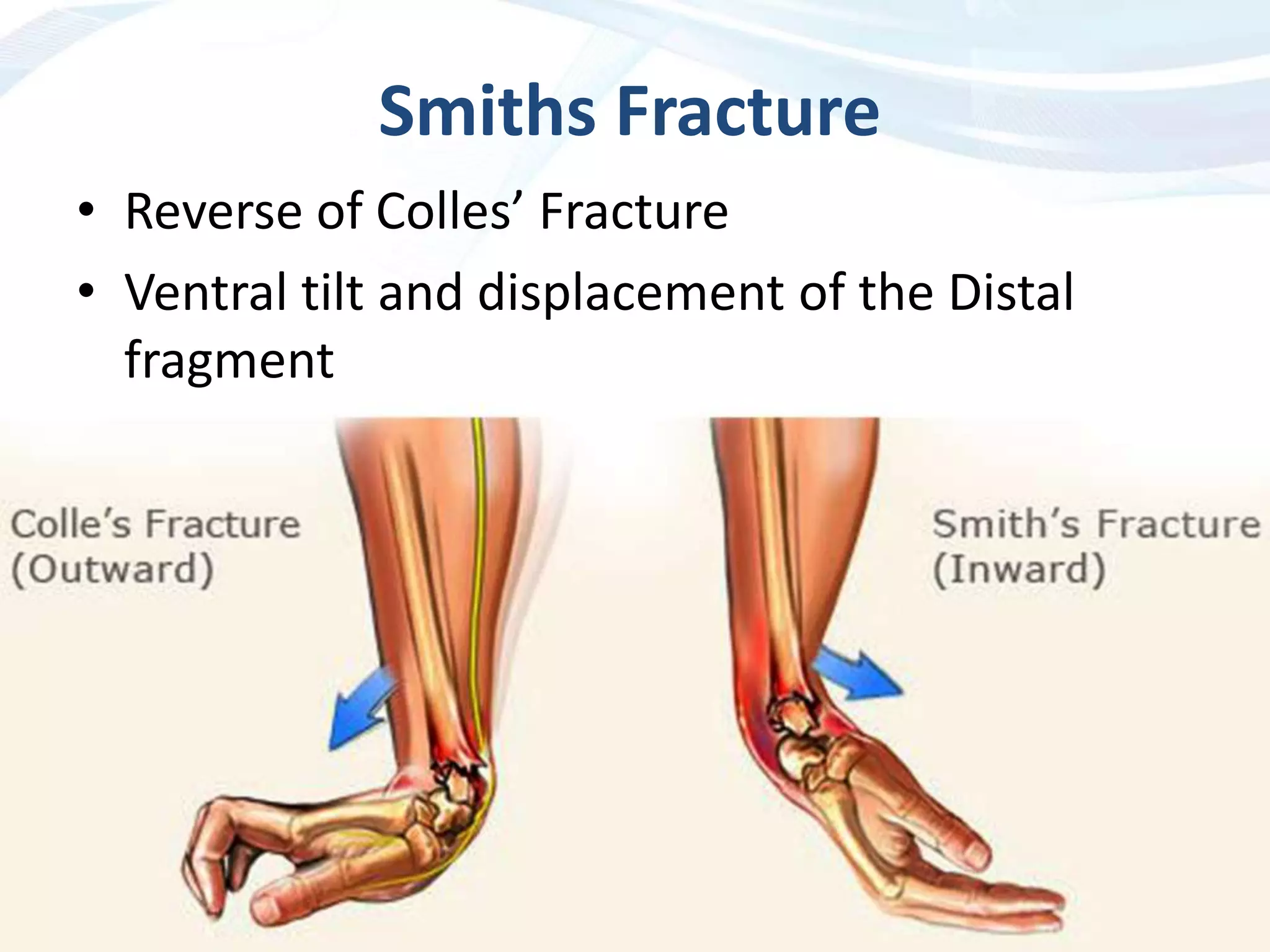 Distal End Radius Fractures - Colles, Smiths & Bartons | PPTX