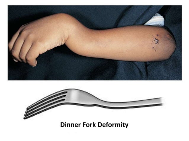 Distal End Radius Fractures - Colles, Smiths & Bartons | PPTX