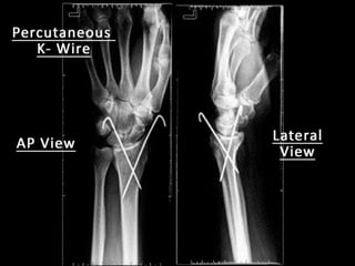 Distal End Radius Fractures - Colles, Smiths & Bartons | PPTX