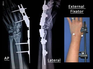 Distal End Radius Fractures - Colles, Smiths & Bartons | PPTX