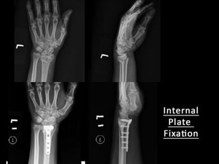 Distal End Radius Fractures - Colles, Smiths & Bartons | PPTX