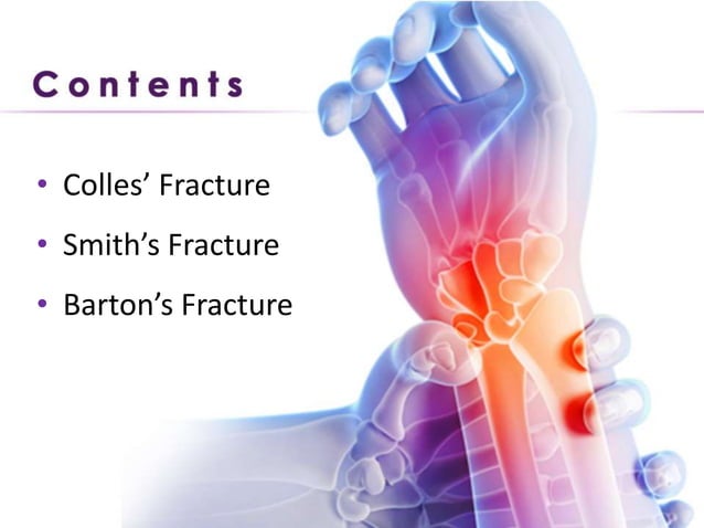 Distal End Radius Fractures - Colles, Smiths & Bartons | PPTX