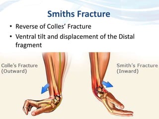 Distal End Radius Fractures - Colles, Smiths & Bartons | PPTX