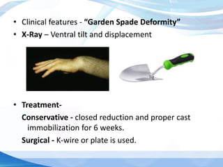 Distal End Radius Fractures - Colles, Smiths & Bartons | PPTX