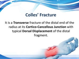 Distal End Radius Fractures - Colles, Smiths & Bartons | PPTX
