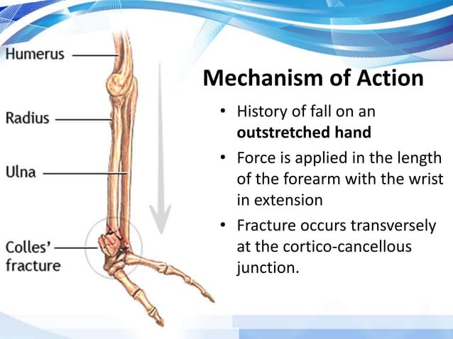 Distal End Radius Fractures - Colles, Smiths & Bartons | PPTX