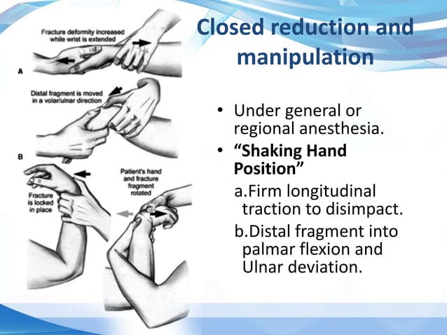 Distal End Radius Fractures - Colles, Smiths & Bartons