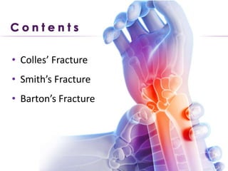 Reverse Colles Fracture