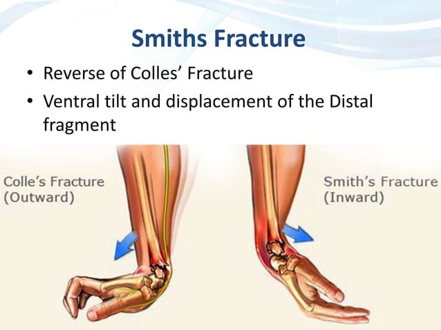 Distal End Radius Fractures - Colles, Smiths & Bartons