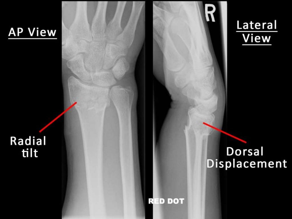 Dorsally displaced distal radius fracture - tolftalking