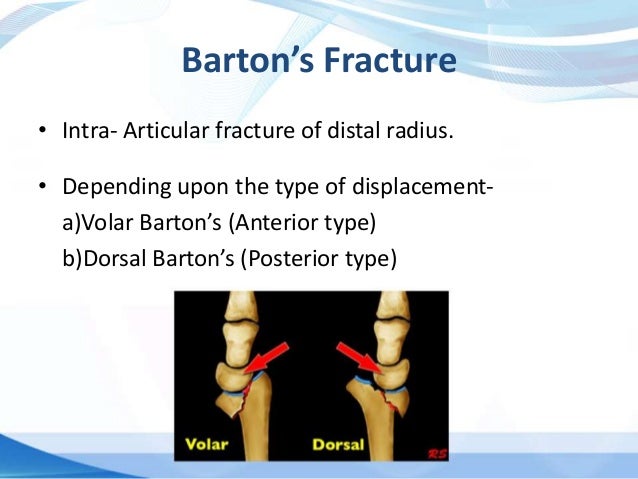 Distal End Radius Fractures - Colles, Smiths & Bartons