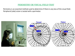 Glaucoma, a major cause of blindness. | PPTX