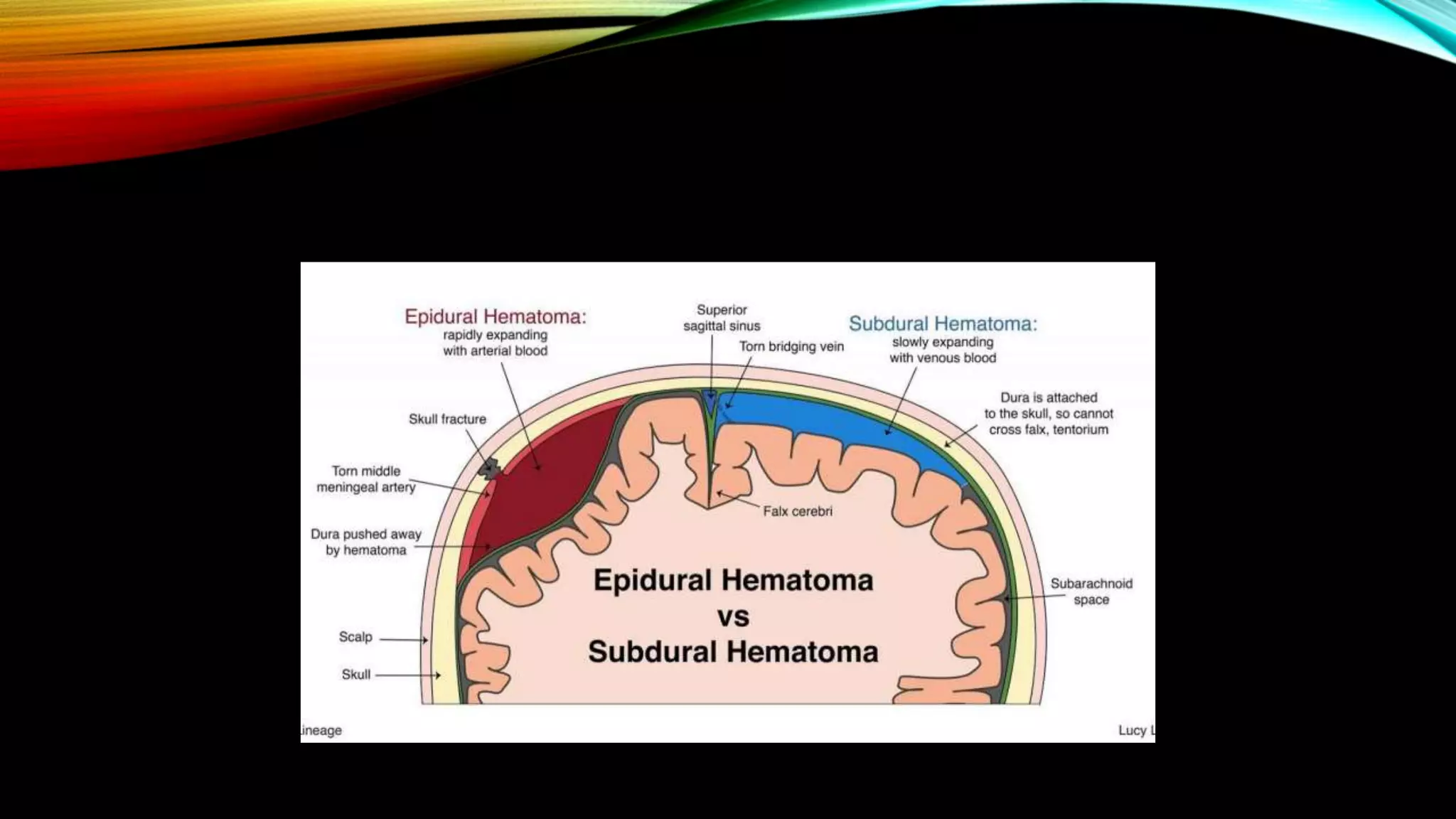 Traumatic Intracranial Hemorrhage | PPTX