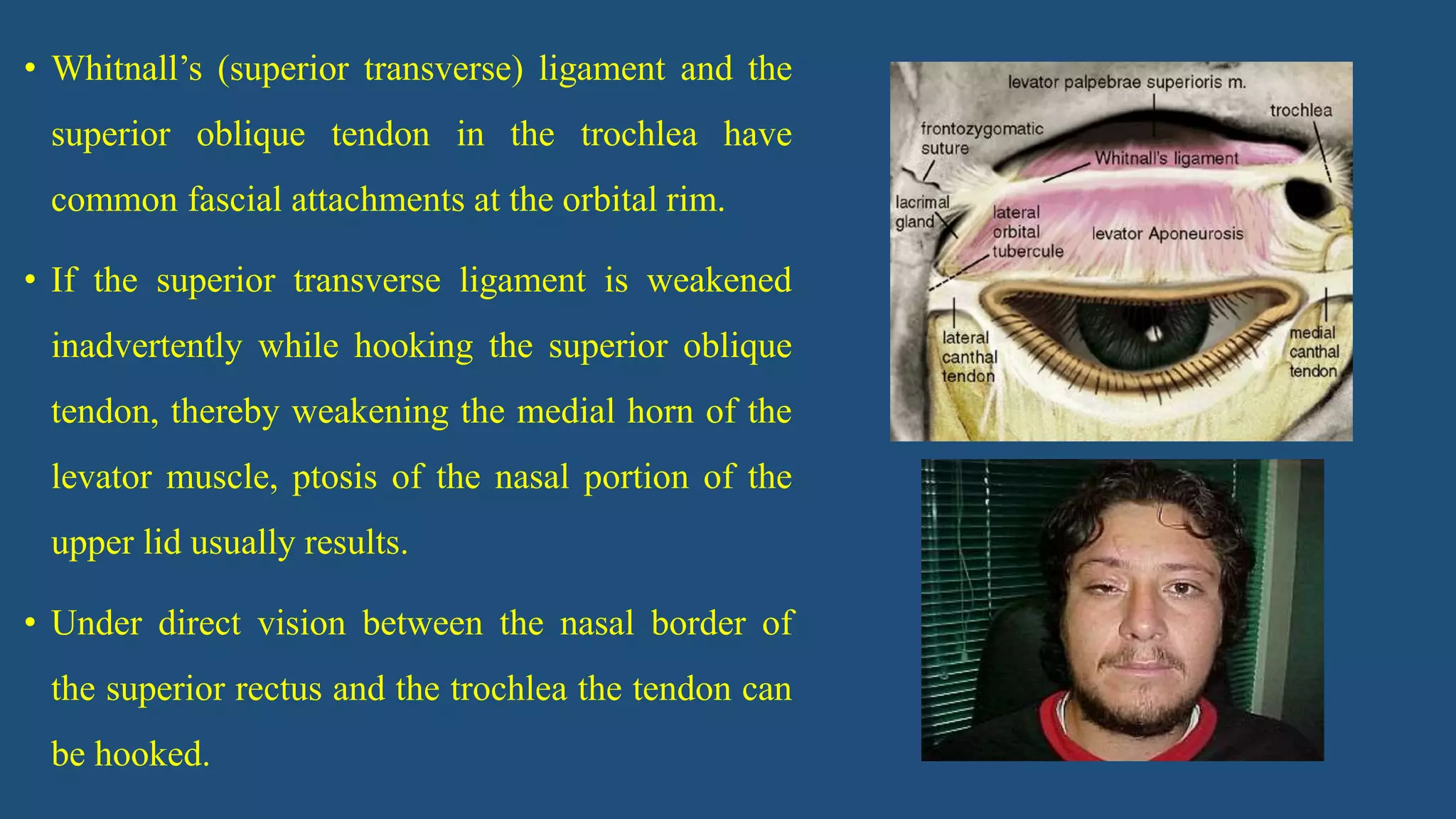 Anatomy of eye and its clinical relevance in Squint | PPTX