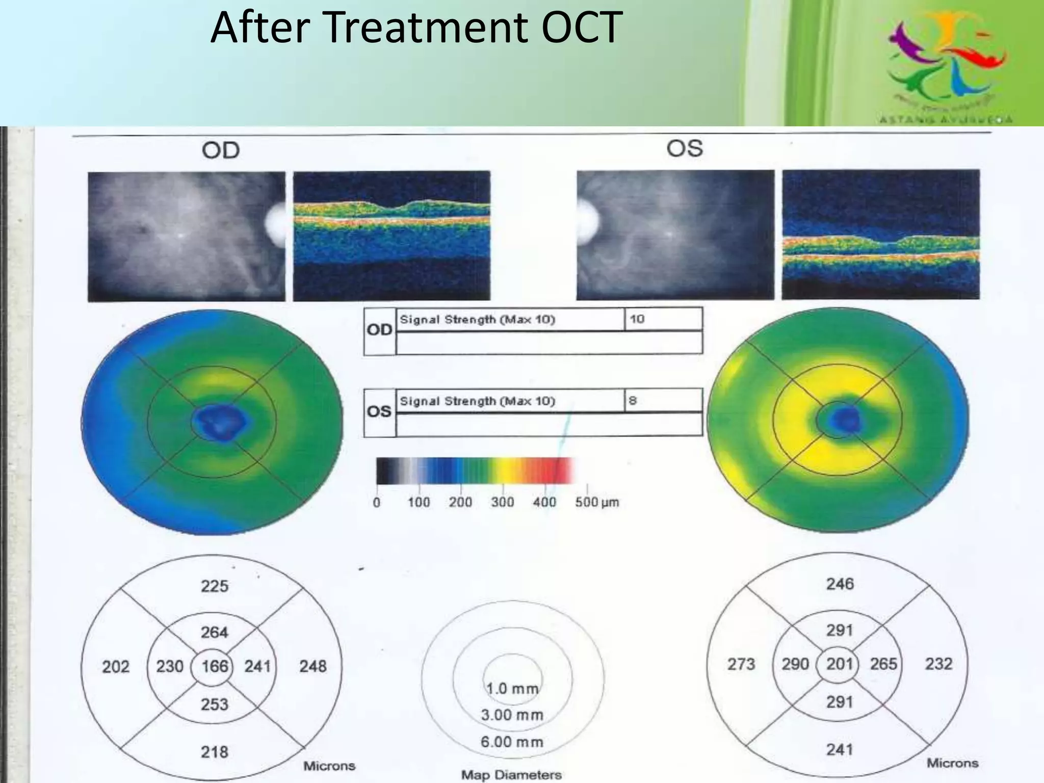 Sucessfully Treatment of Central Serous Chorioretinopathy, CSR in ...