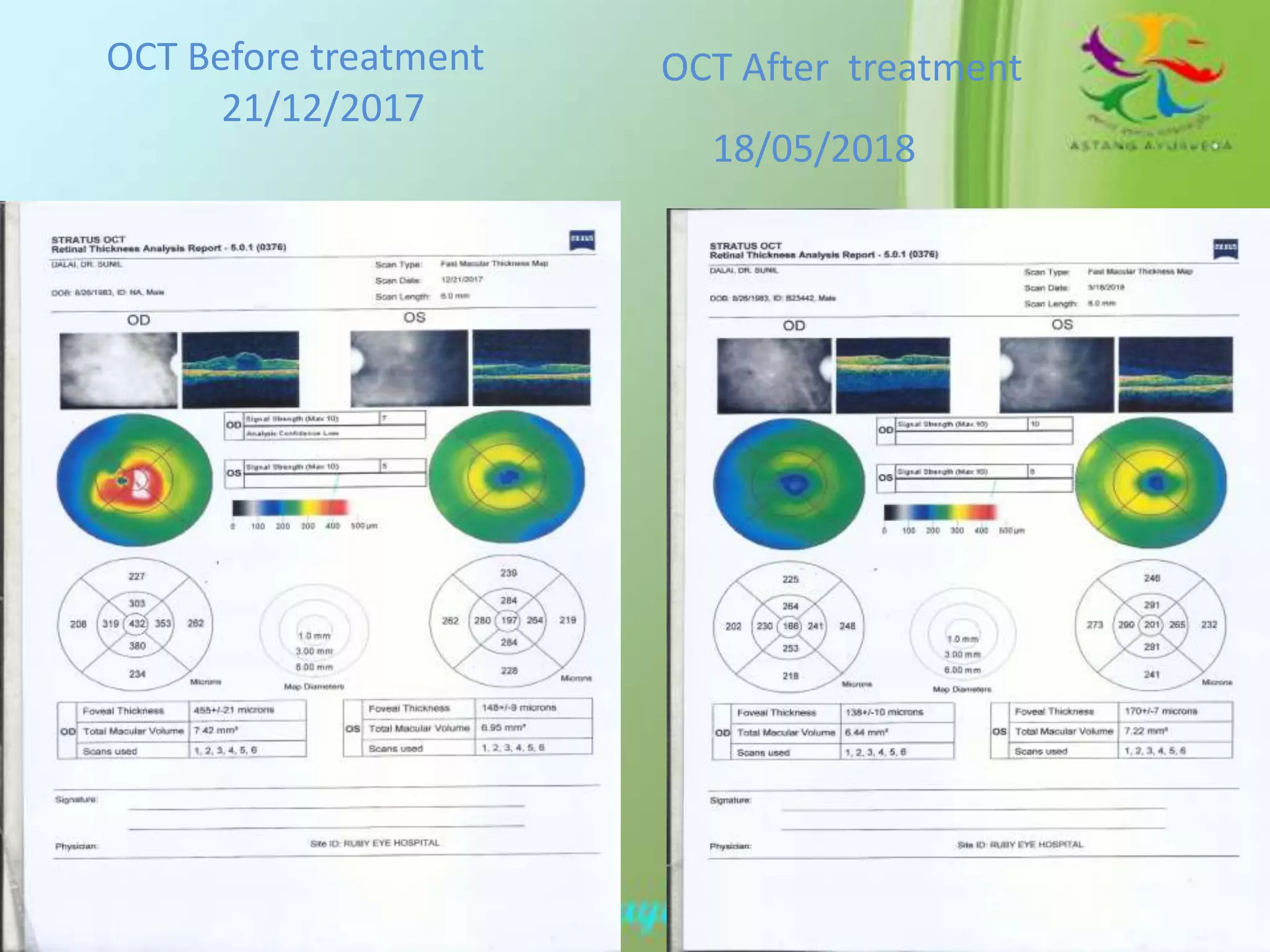Sucessfully Treatment of Central Serous Chorioretinopathy, CSR in ...