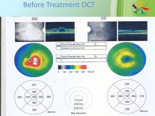 Sucessfully Treatment of Central Serous Chorioretinopathy, CSR in ...