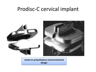 Artificial disc replacement vs ACDF | PPTX