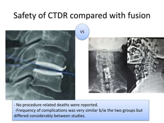 Artificial disc replacement vs ACDF | PPTX