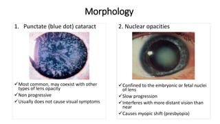 Congenital Catarct | PPTX