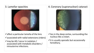 Congenital Catarct | PPTX