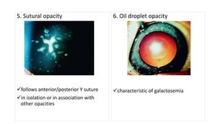 Congenital Catarct | PPTX