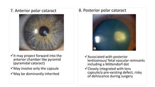Congenital Catarct | PPTX